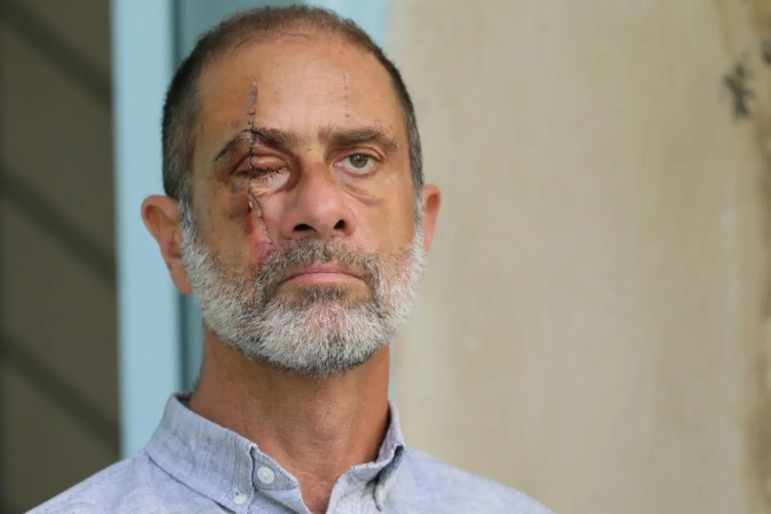 'Vision From Hell': Losing an Eye to the Beirut Blast