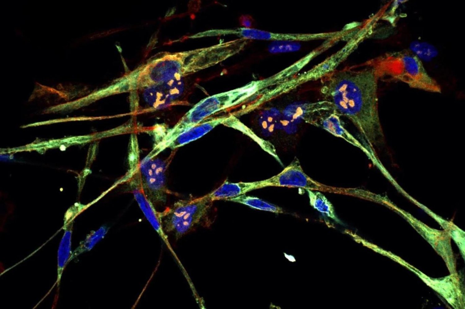 Tıpta yeni atılım: Agresif kanser hücreleri kasa dönüştürüldü