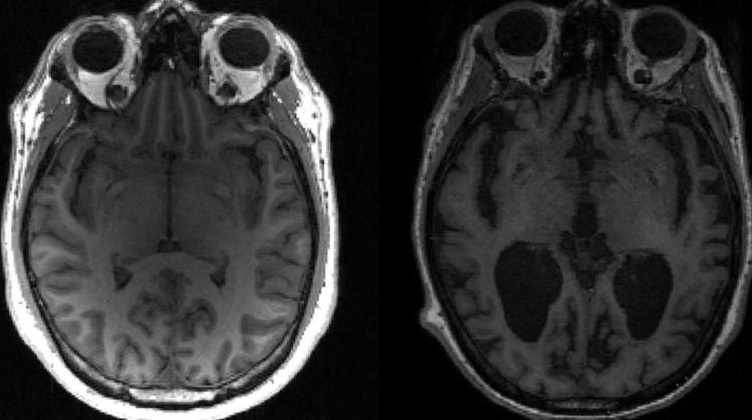 US Approves New Drug to Treat Alzheimer's Disease