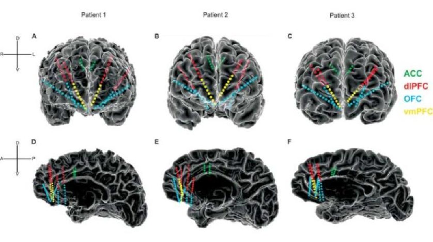 Depresyonun kodlarının çözülmesi için sinir devreleri inceleniyor