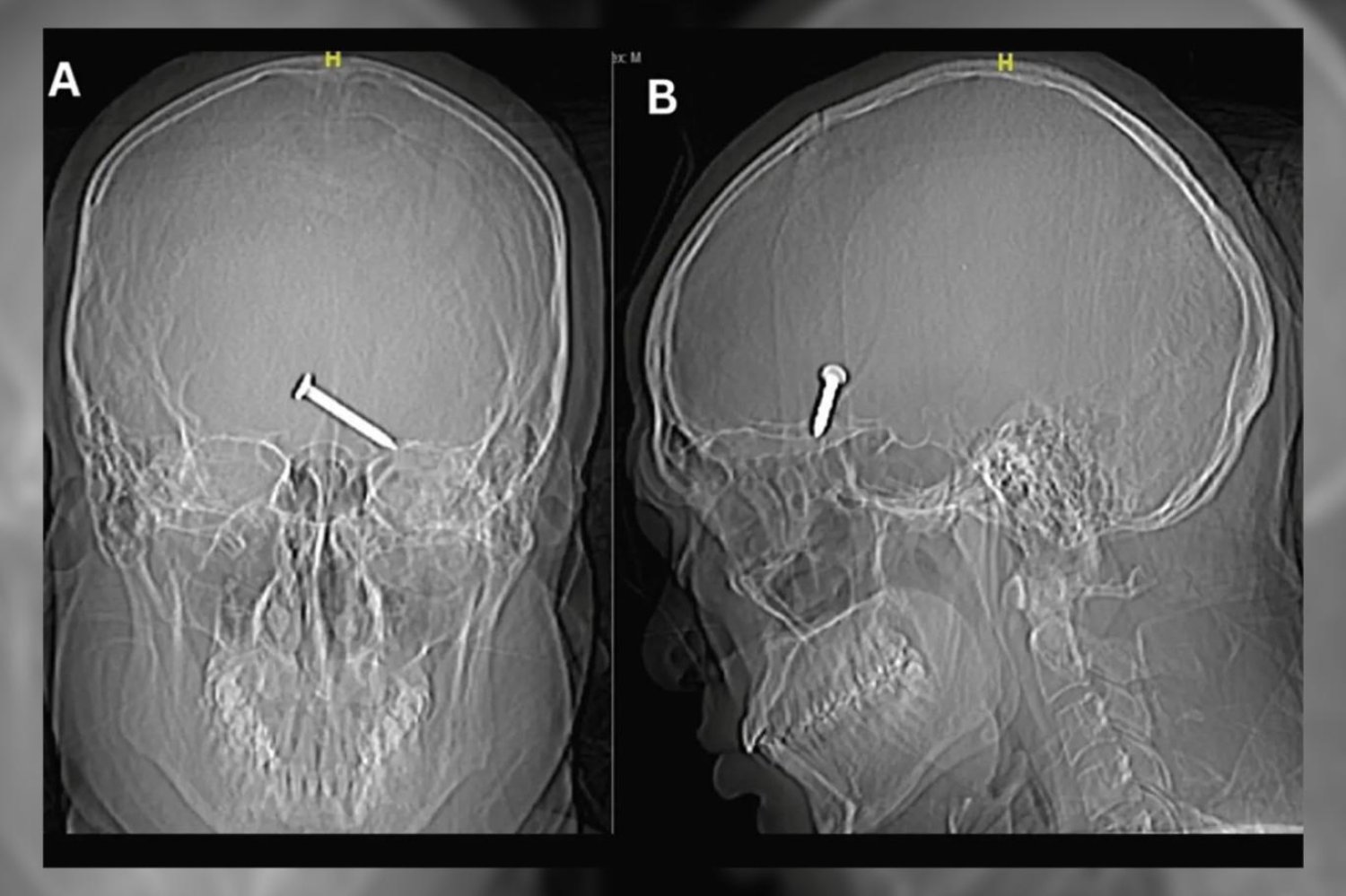 Çivi tabancasıyla kendini vurma hikayesi, bilimsel araştırmayla gözler ...