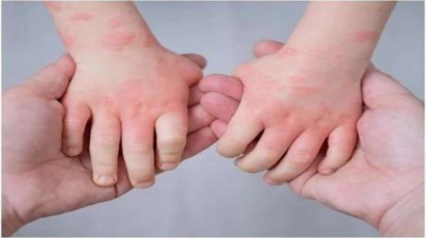 Hindistan’da ortaya çıkan domates gribi nedir ve nasıl yayılır?