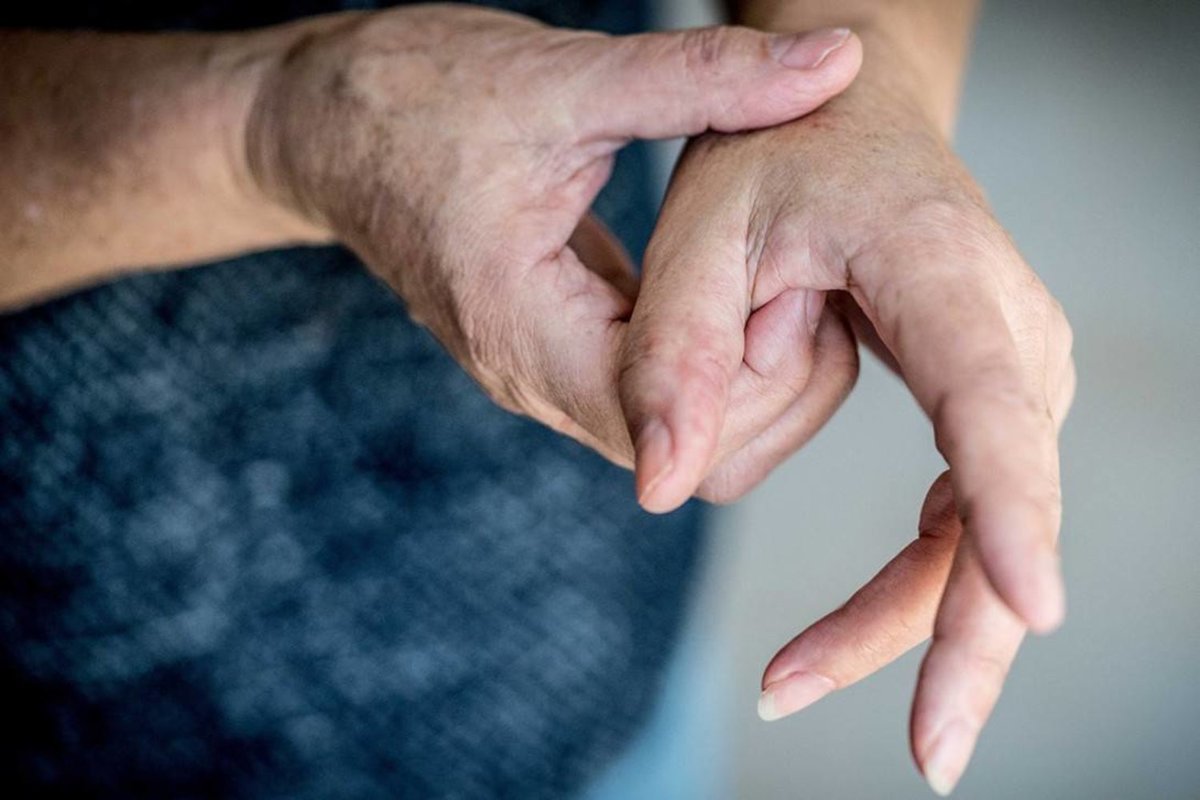 Yeni bir tedavi ağrılı el artritinin semptomlarını hafifletiyor