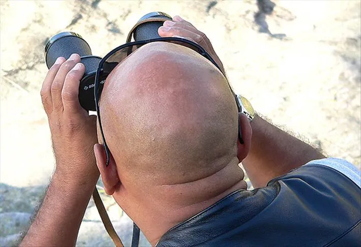 Yeni araştırma: Şekerli içecek tüketenler daha fazla kelleşiyor