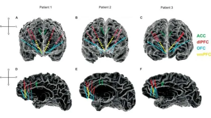 Depresyonun kodlarının çözülmesi için sinir devreleri inceleniyor